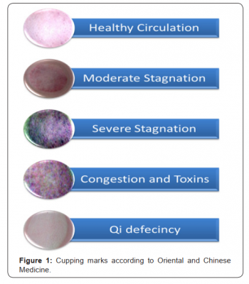 Cupping Hijama Therapy 101 – Core Balance Movement